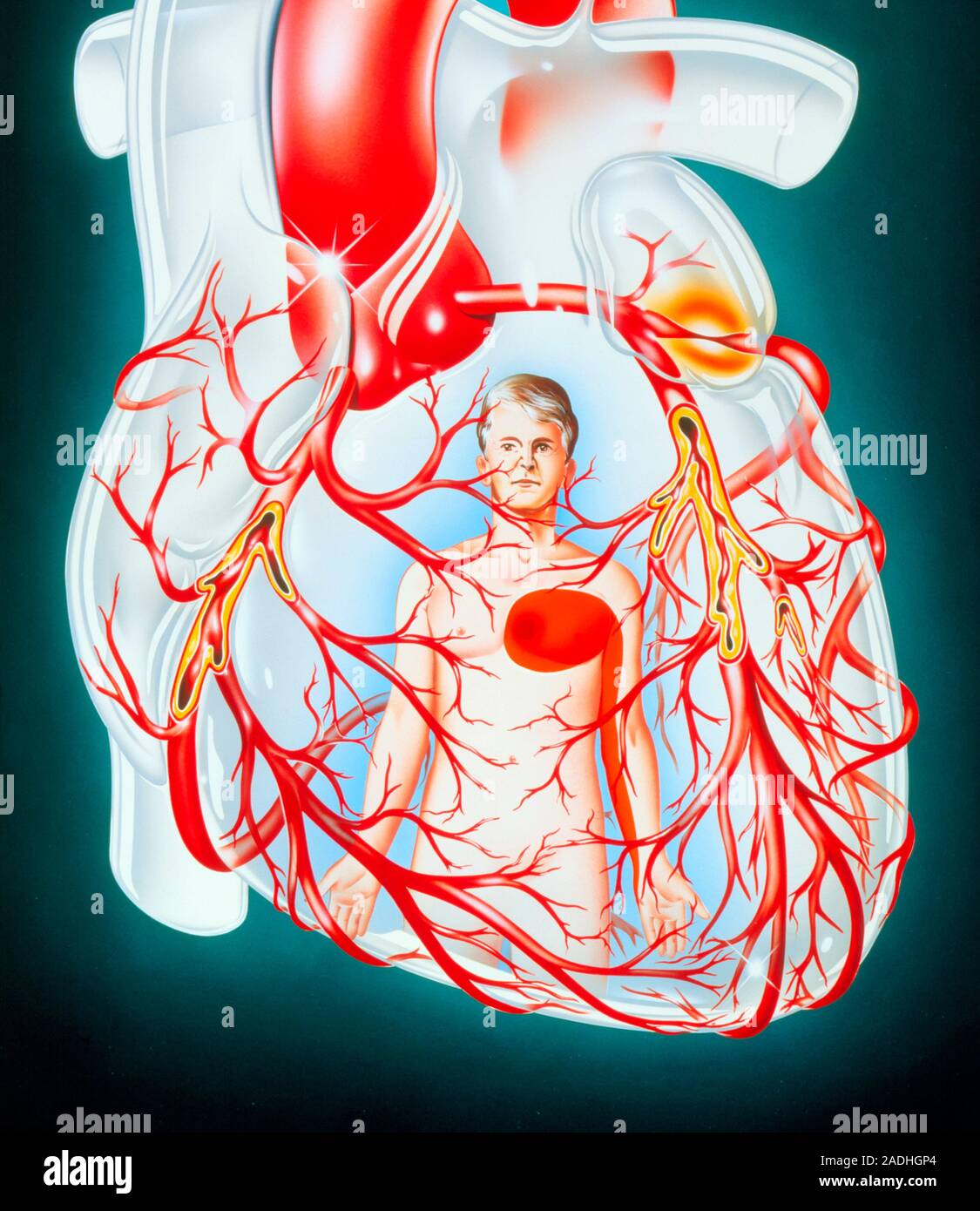 Angina pectoris. Illustration of the heart of a man suffering from the ...