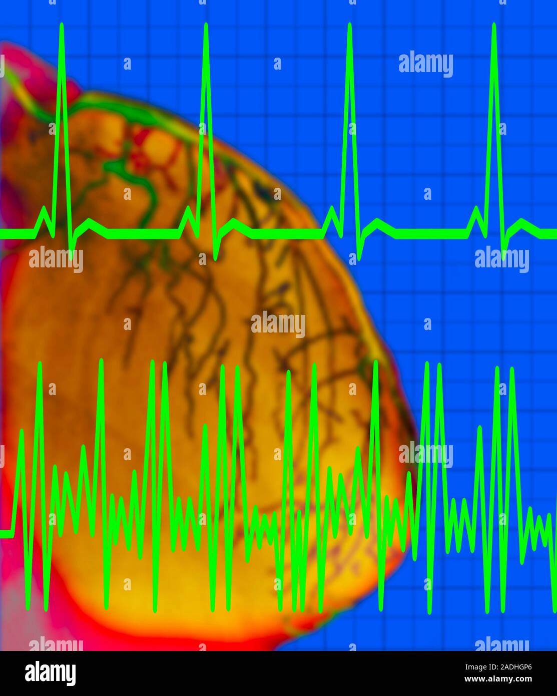 Heart attack. Computer composite artwork depicting a heart attack ...