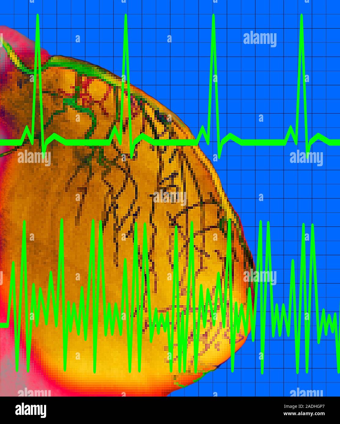 Heart attack. Computer composite artwork depicting a heart attack ...