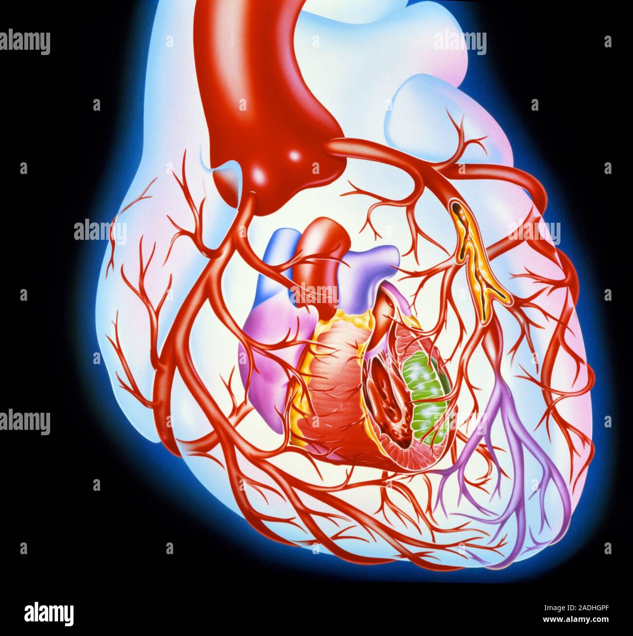 Angina pectoris. Artwork of the heart within a heart showing the causes ...