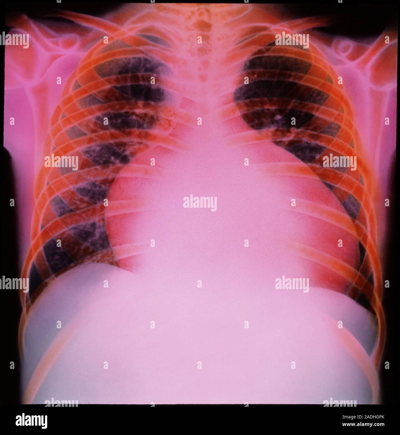 Cardiomyopathy. Coloured chest X-ray of a child with cardiomyopathy ...