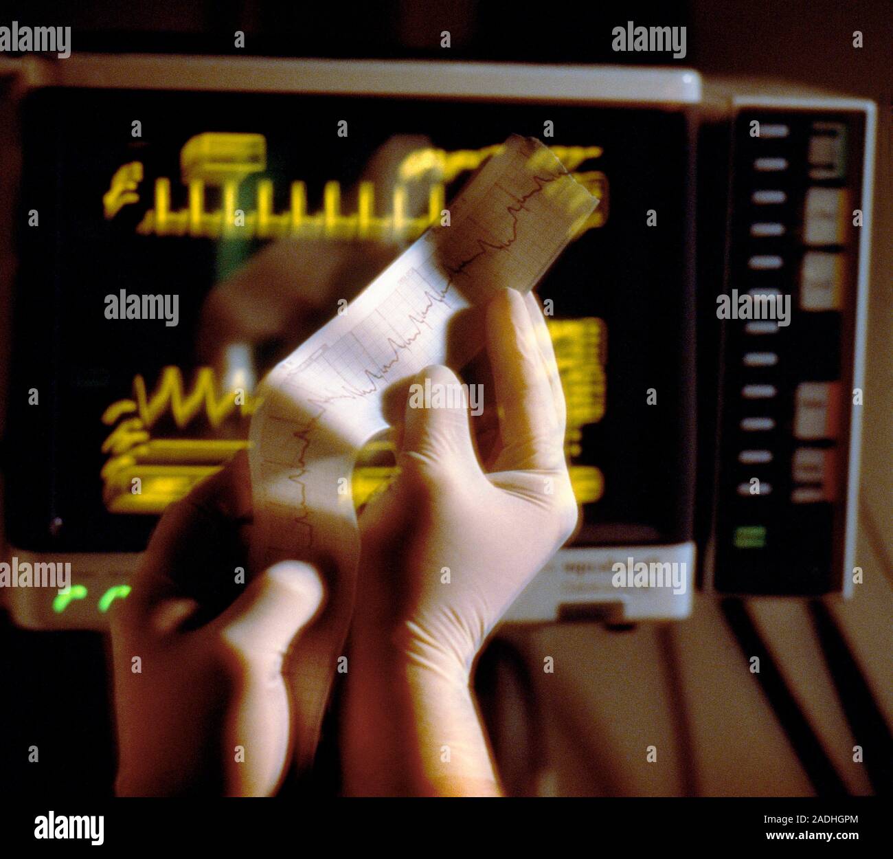 Heart attack ECG. Gloved hands holding an ECG (electrocardiograph ...