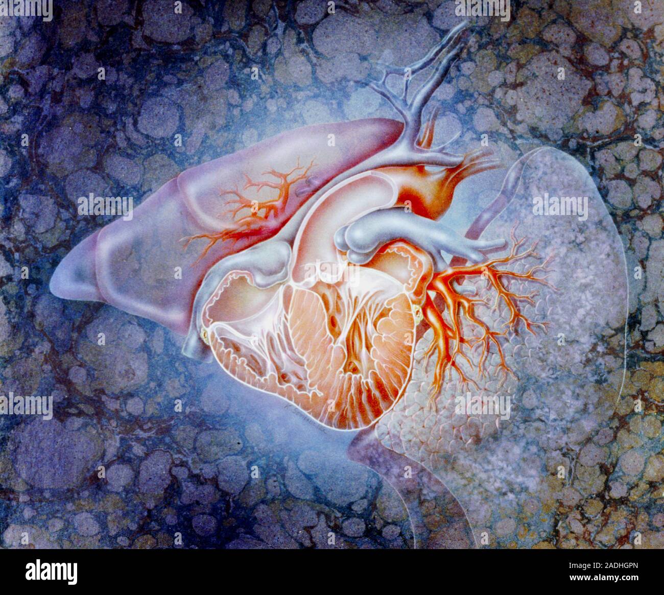 Heart failure. Artwork of a section through a human heart with ...