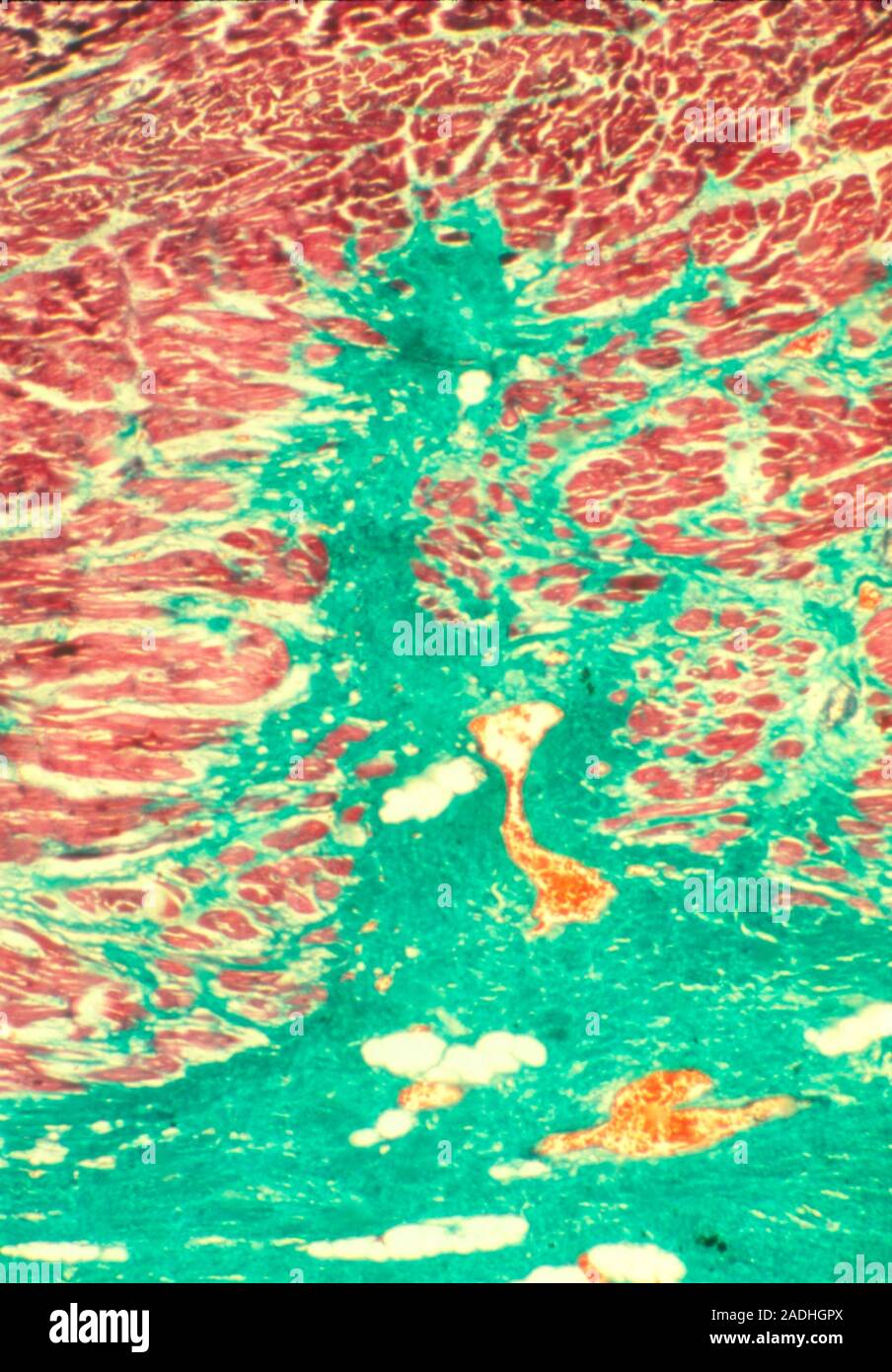 Heart attack scar. Light micrograph of scar tissue (blue/green) formed ...