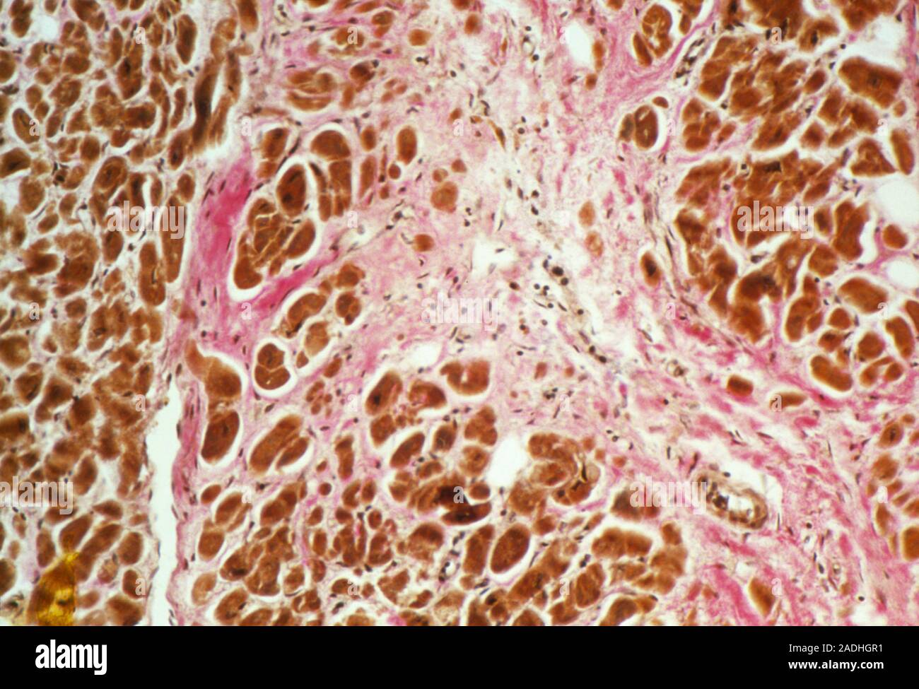 Heart attack scar. Light micrograph of sectioned scar tissue (pink ...