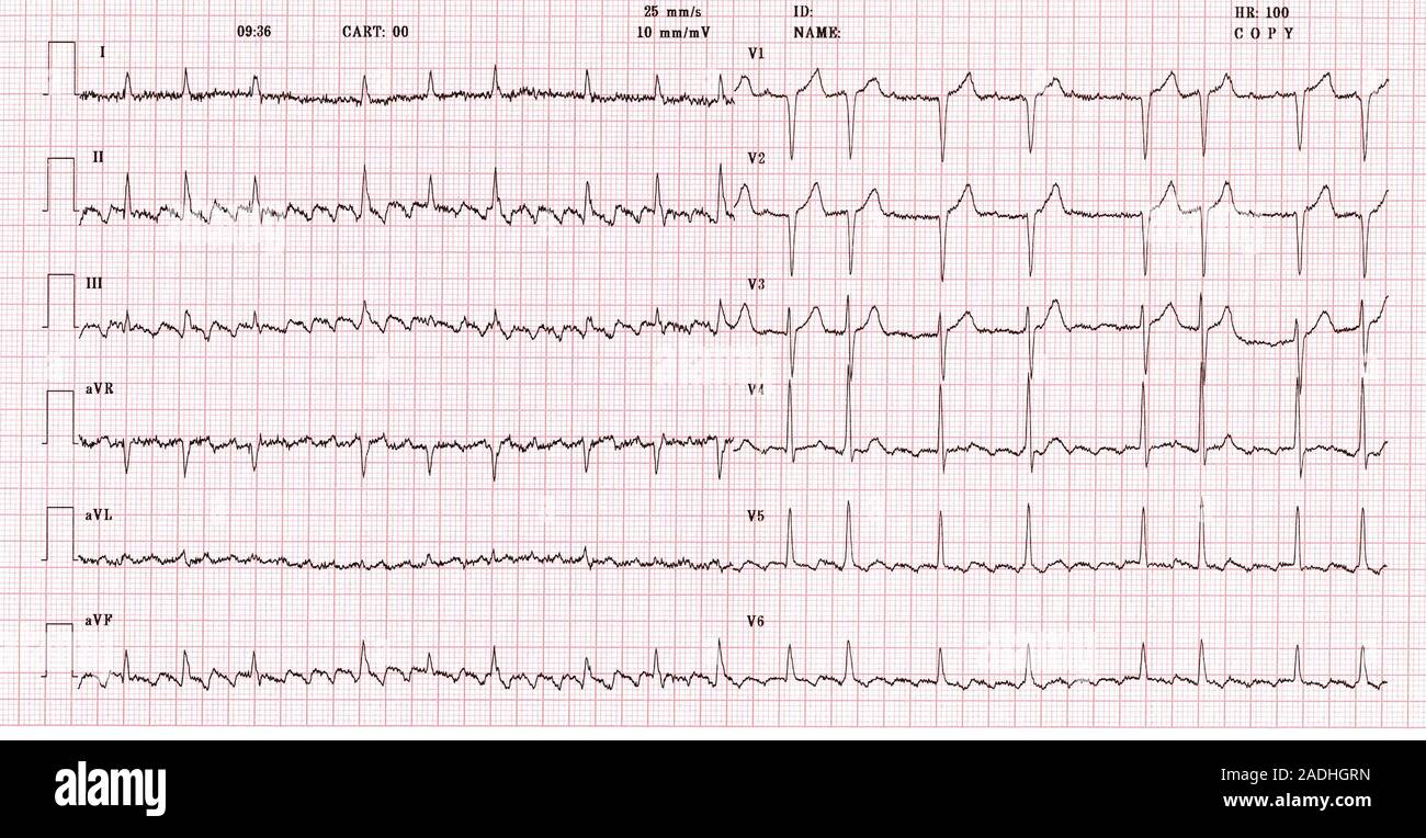 Heart disease. Electrocardiogram (ECG) of the heartbeat of a 76-year ...
