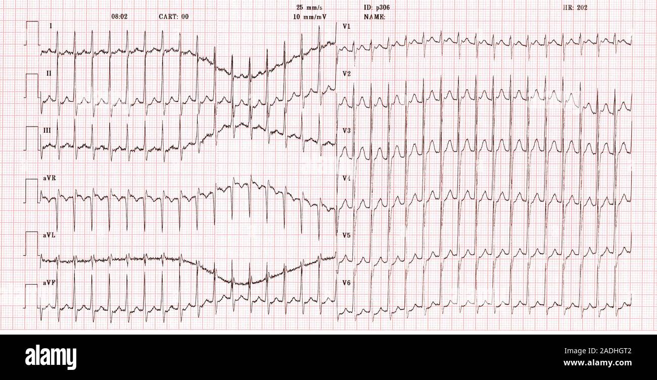 Heart disease. Electrocardiogram (ECG) of the heartbeat of an 18-year ...