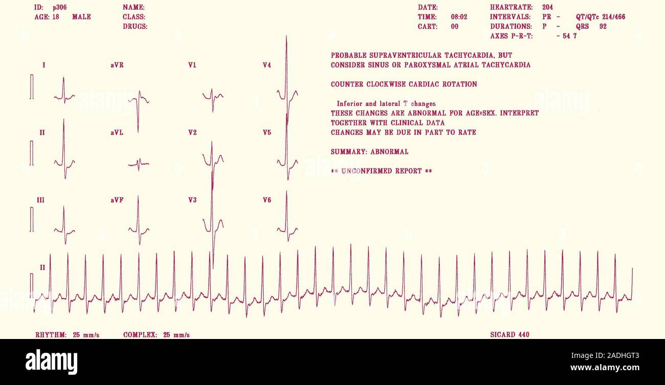 Heart disease. Electrocardiogram (ECG) of the heartbeat of an 18-year ...