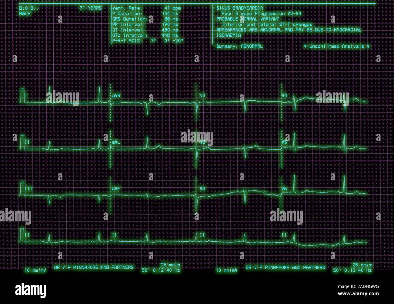 Heart disease. Electrocardiogram (ECG) showing the heartbeat during ...