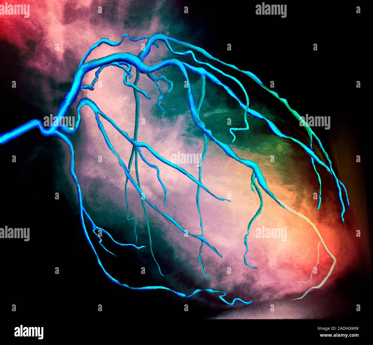 Heart disease. Coloured X-ray angiogram of the heart of a patient who ...