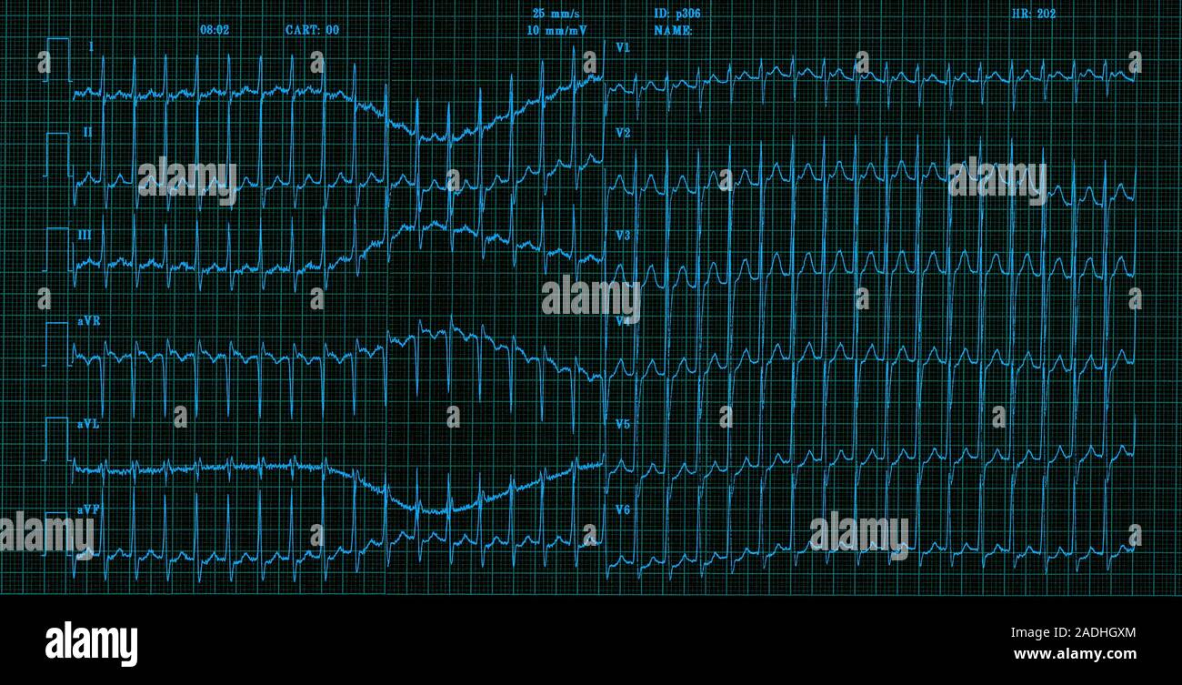 Heart disease. Electrocardiogram (ECG) of the heartbeat of an 18-year ...