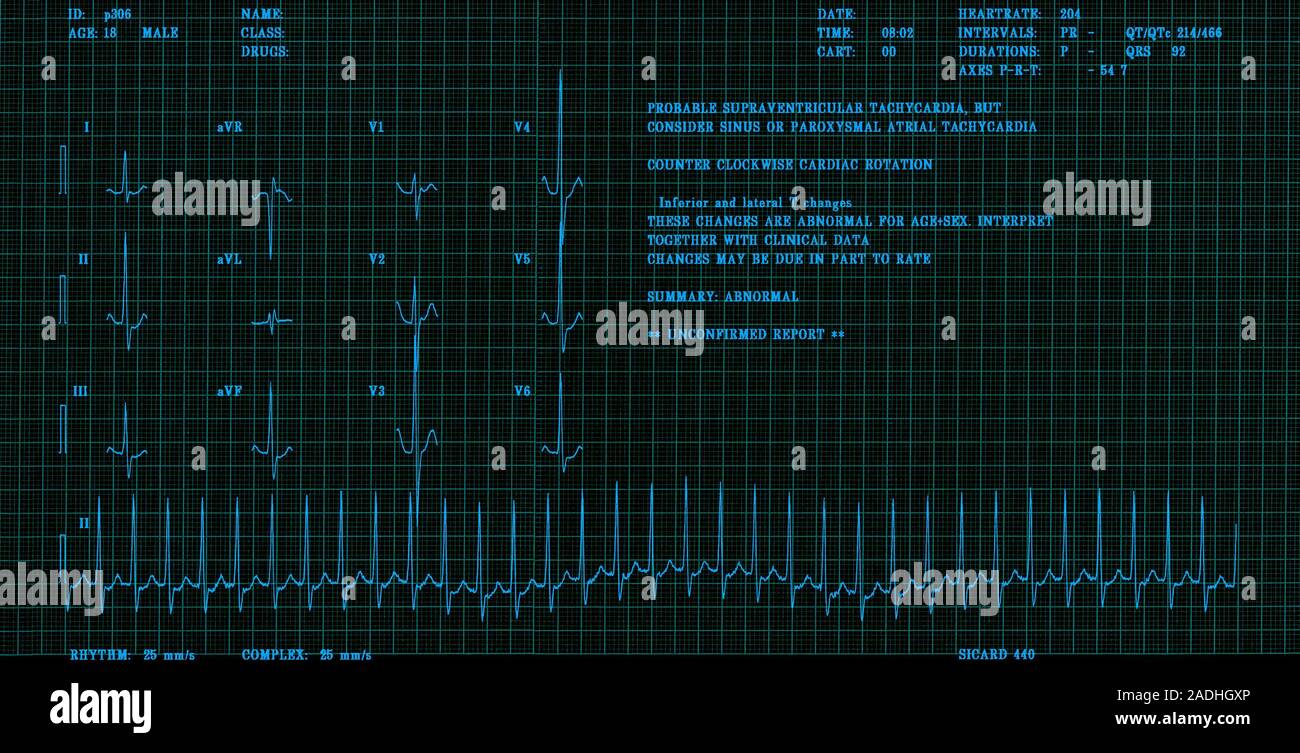 Heart disease. Electrocardiogram (ECG) of the heartbeat of an 18-year ...