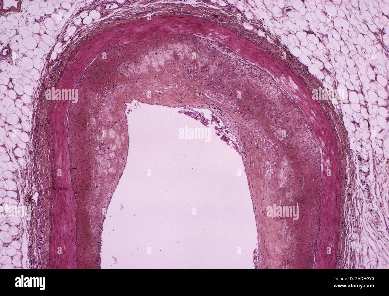 Coronary artery disease. Light micrograph of a section through a ...