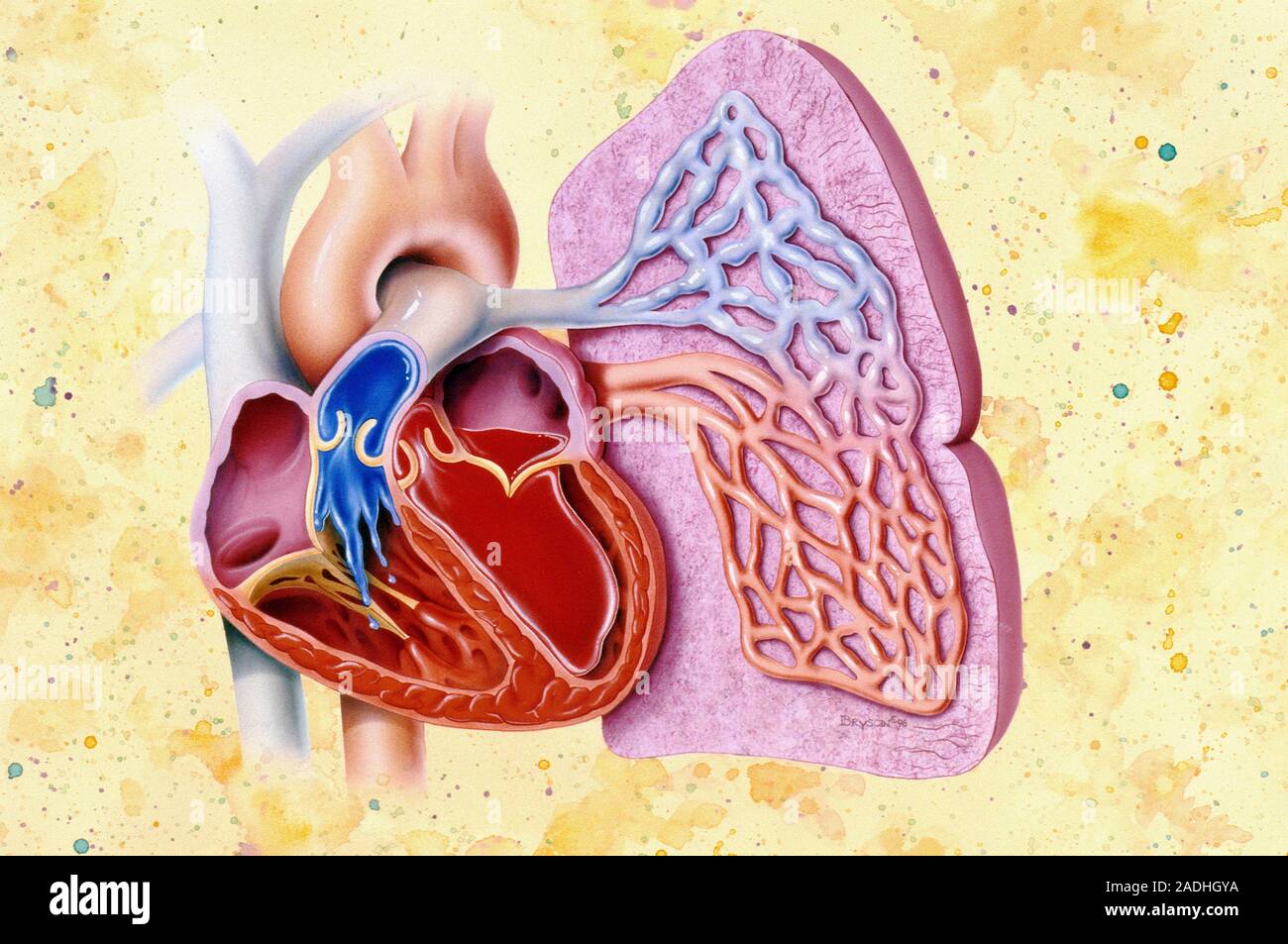 Heart failure. Cutaway illustration of a human heart with congestive ...