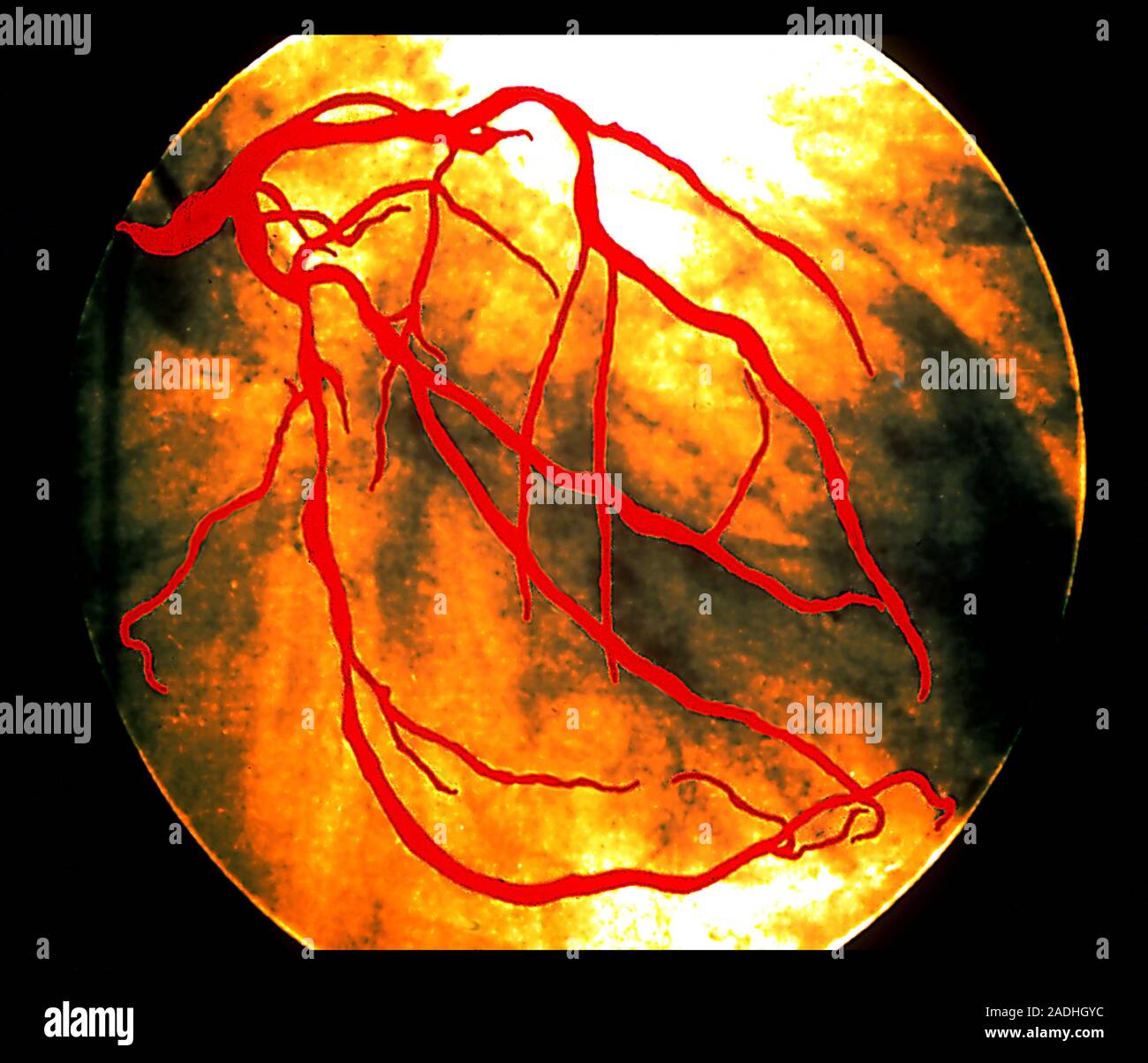 Heart disease. Coloured angiogram (X-ray) of the coronary (heart ...