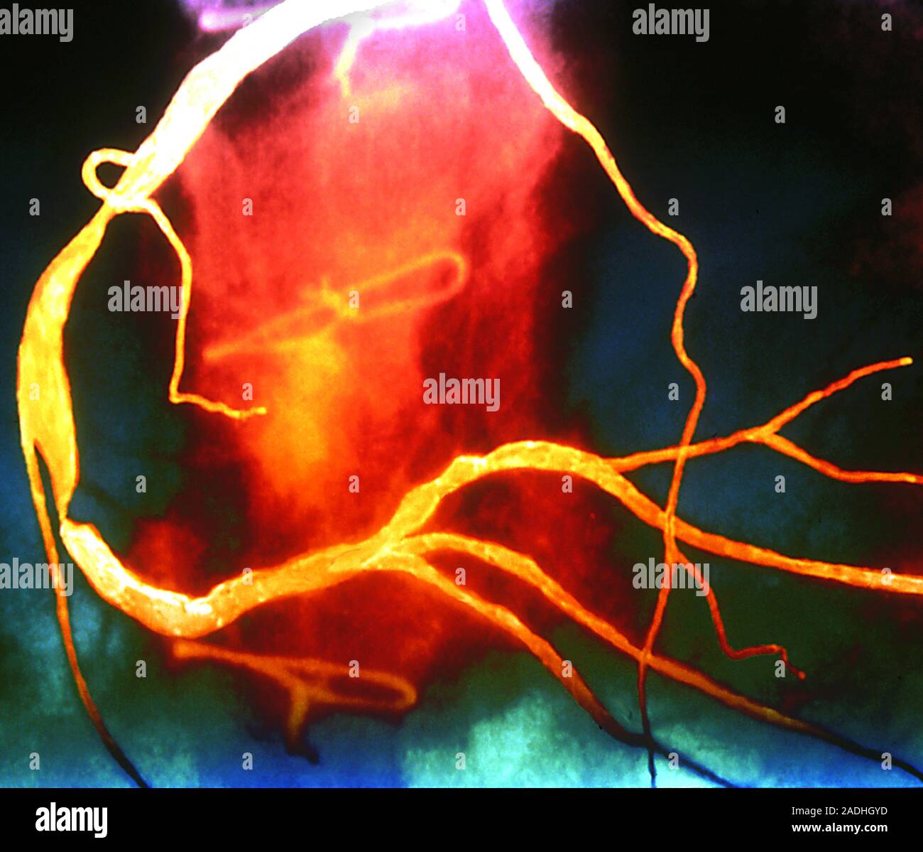Heart disease. Coloured angiogram (X-ray) of the coronary (heart ...