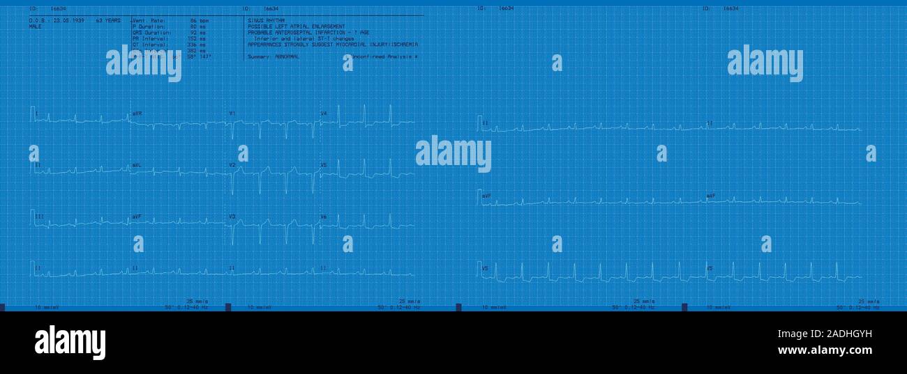Heart disease diagnosis. Electrocardiogram (ECG) showing the heartbeat ...