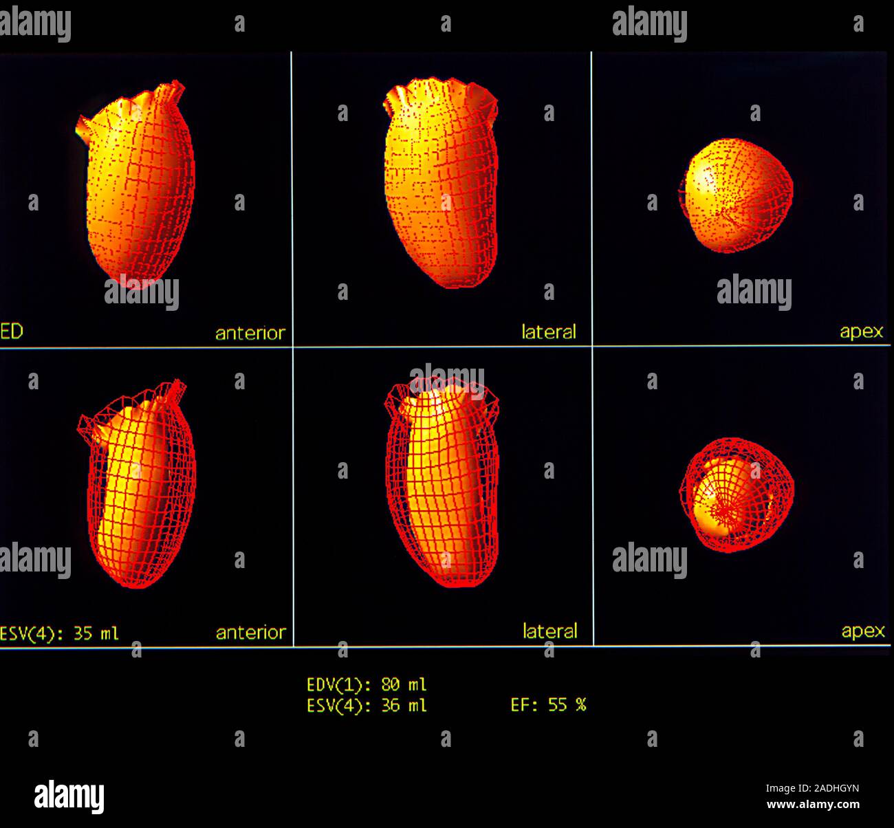 Heart after heart attack. Three-dimensional models based on gamma ...