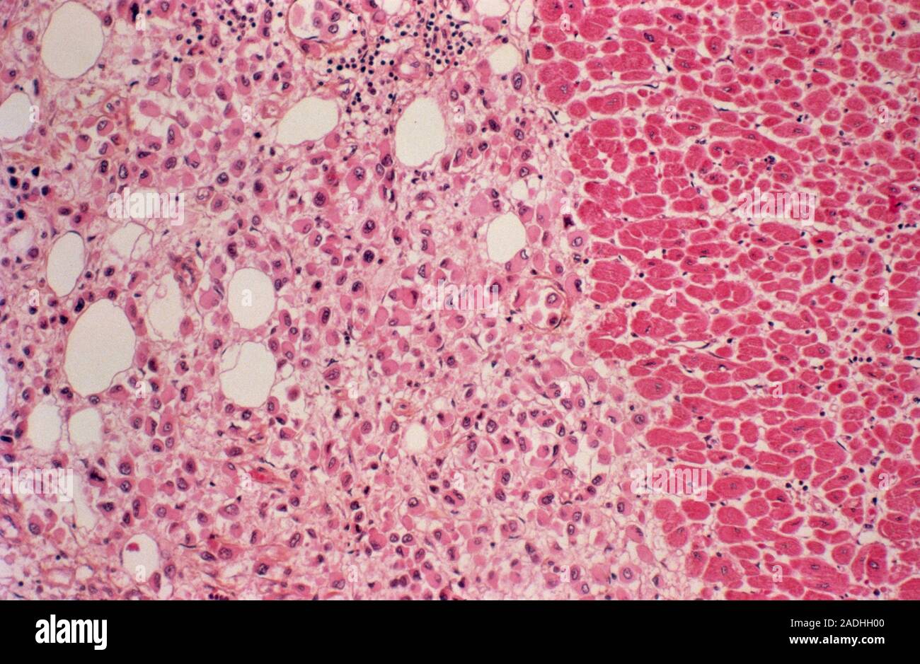 Inflamed heart sac. Light micrograph of a section through tissue from a ...