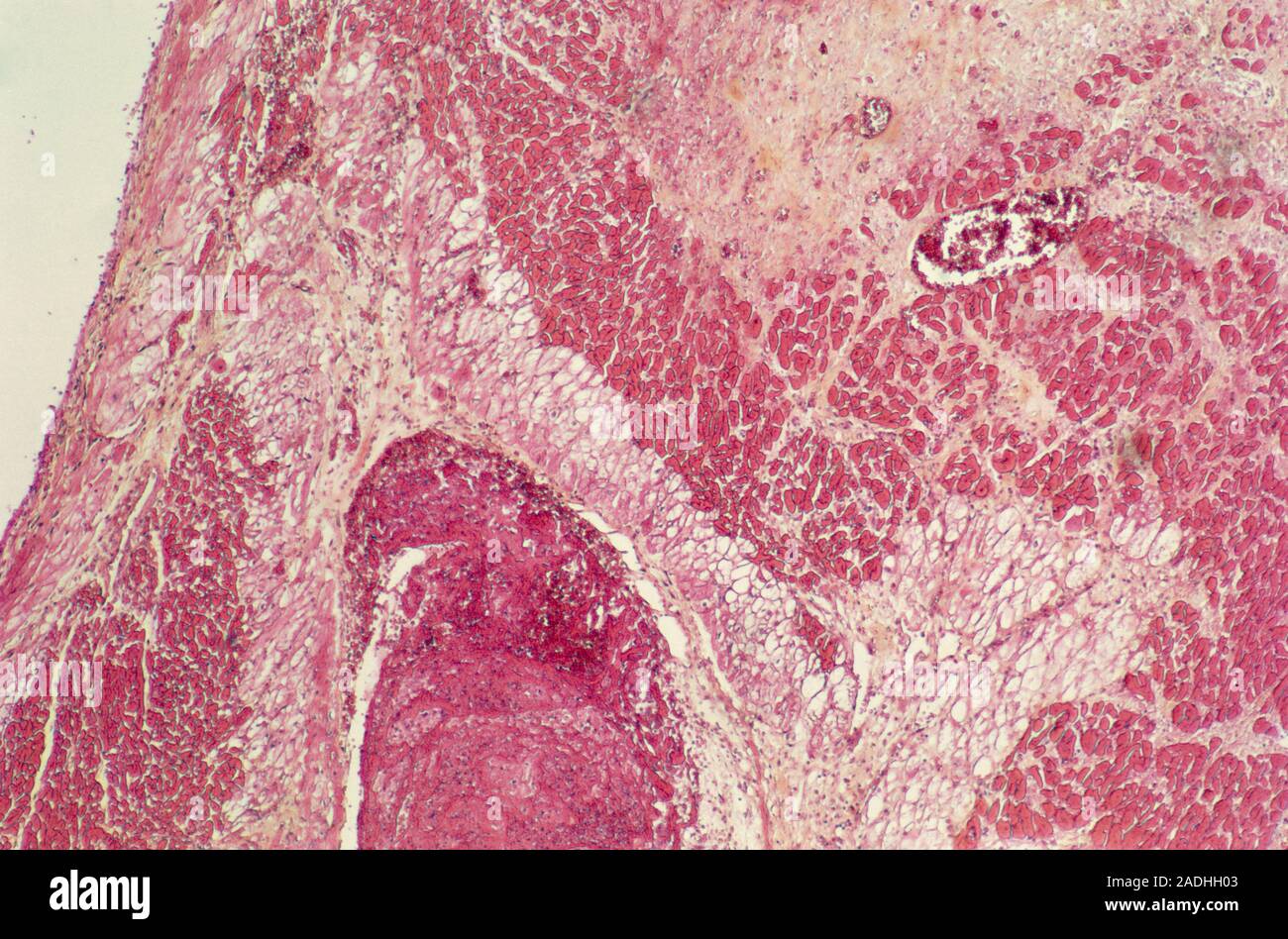 Heart tissue death. Light micrograph of a section through heart muscle ...