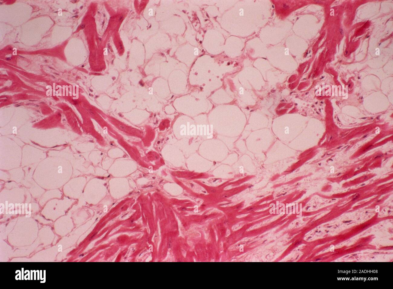 Heart fat deposits. Light micrograph of a section through heart tissue ...
