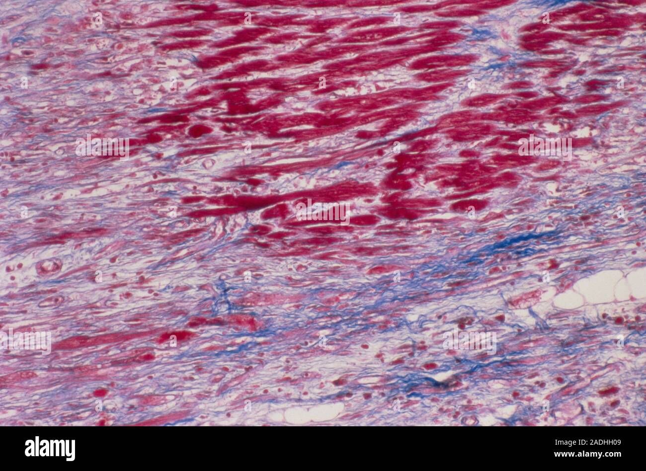 Diseased heart tissue. Light micrograph of a section through diseased ...