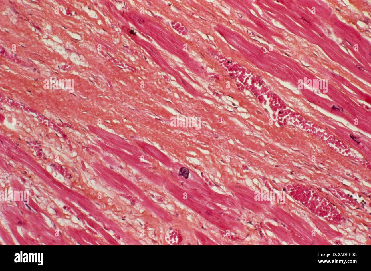 Heart attack. Light micrograph of a section through heart tissue in a ...
