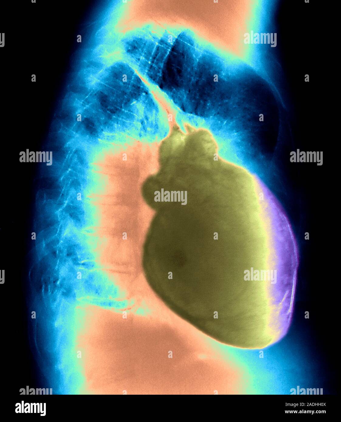 Heart inflammation. Coloured X-ray of a patient's chest in profile ...