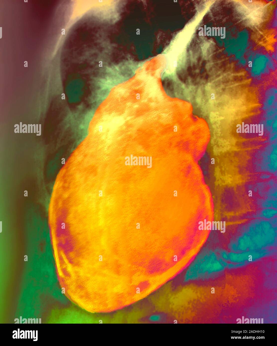 Heart inflammation. Coloured X-ray of a patient's heart (orange) in ...