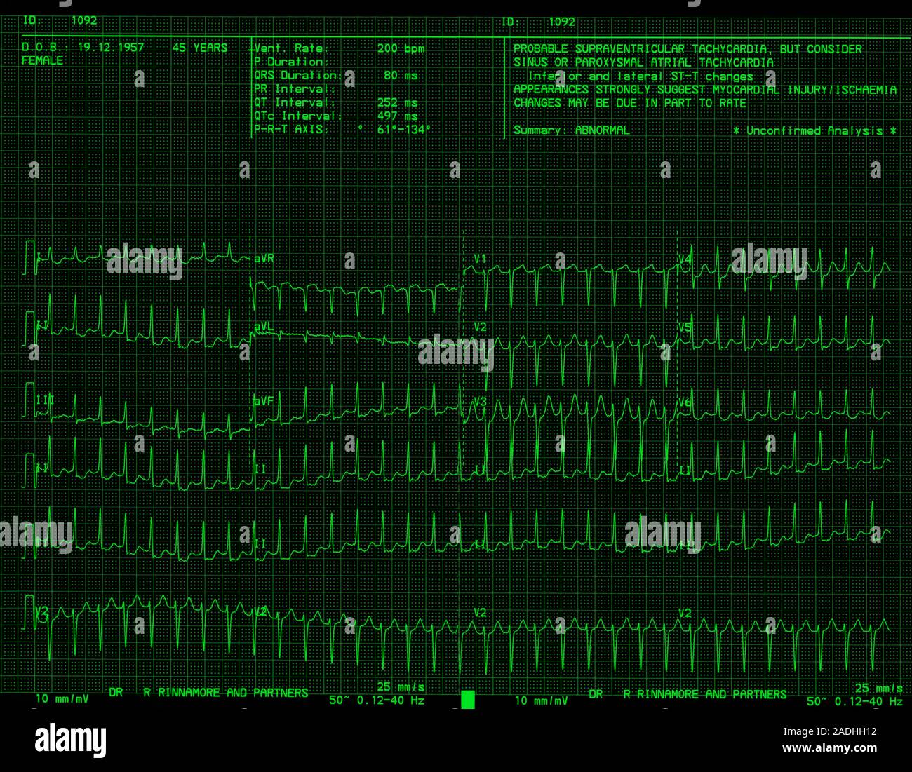 Heart disease. Abnormal electrocardiogram (ECG) of the heartbeat of a ...