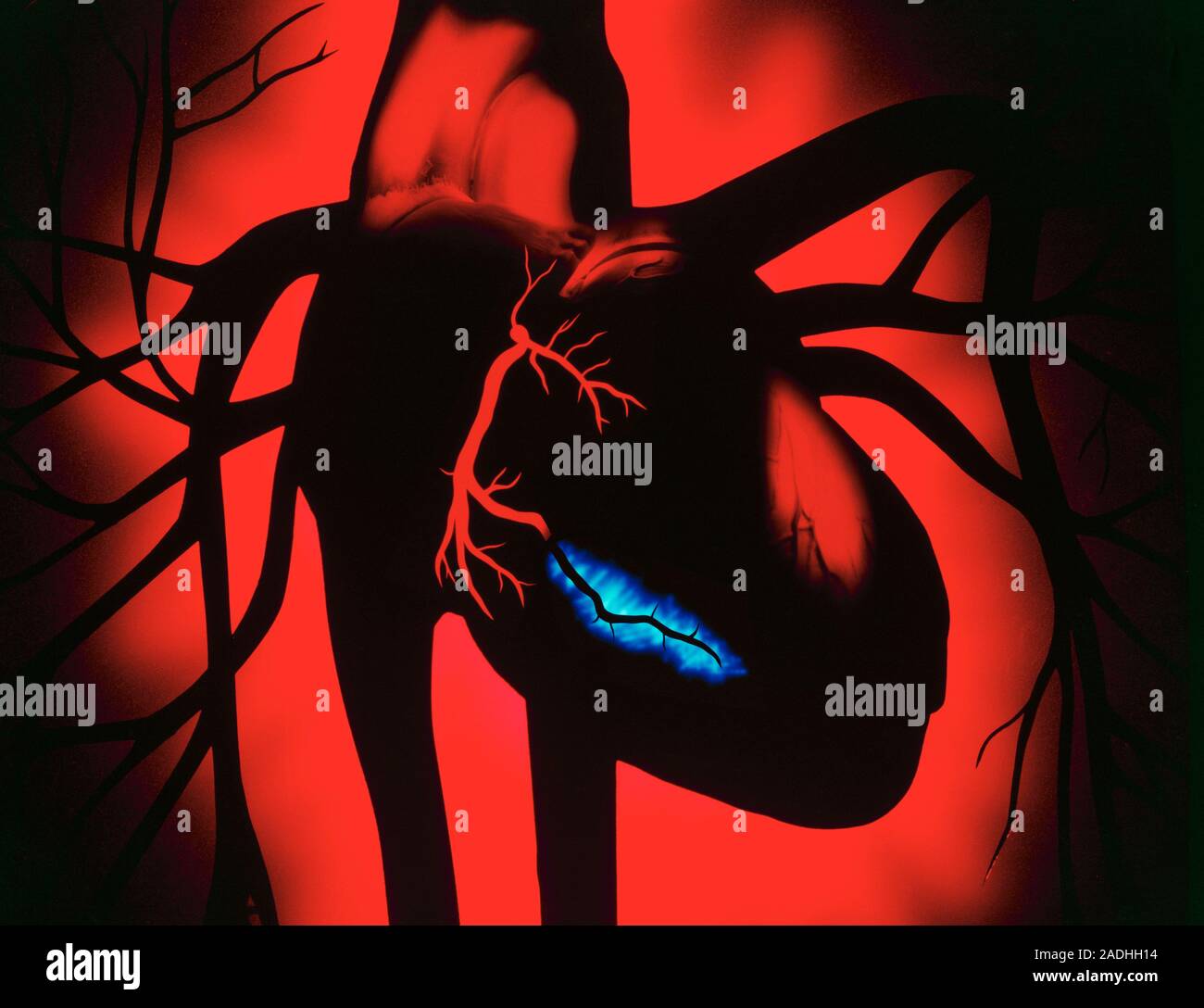 Heart attack. Conceptual computer artwork representing a heart attack ...
