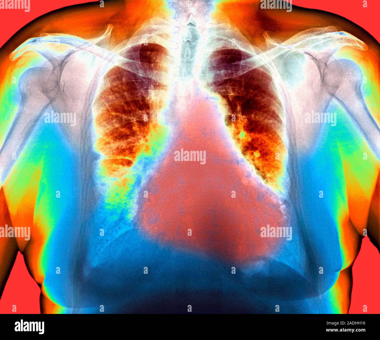 Enlarged heart. Coloured chest X-ray of a female patient with gross ...
