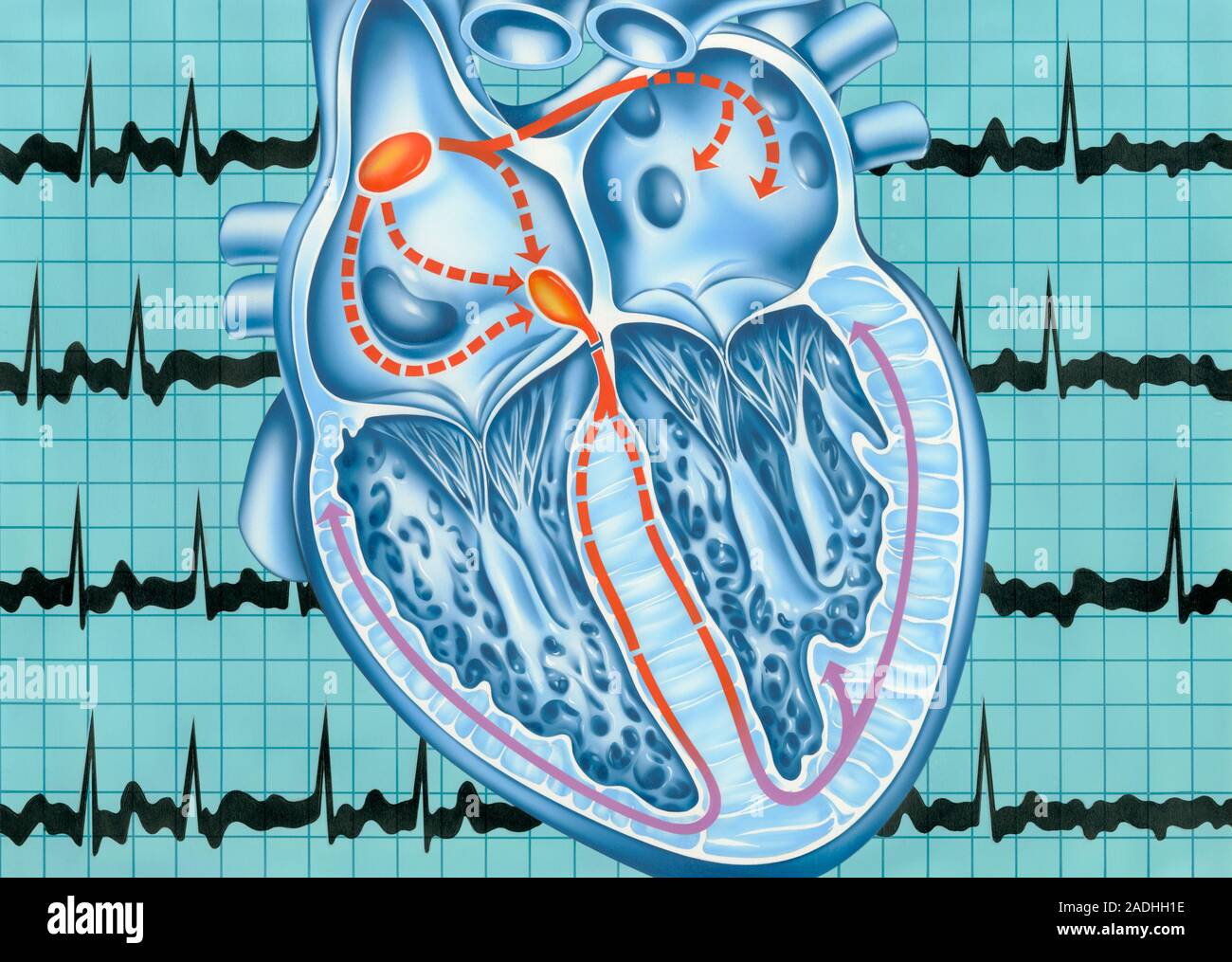 Atrial fibrillation. Artwork of a section through a human heart during ...