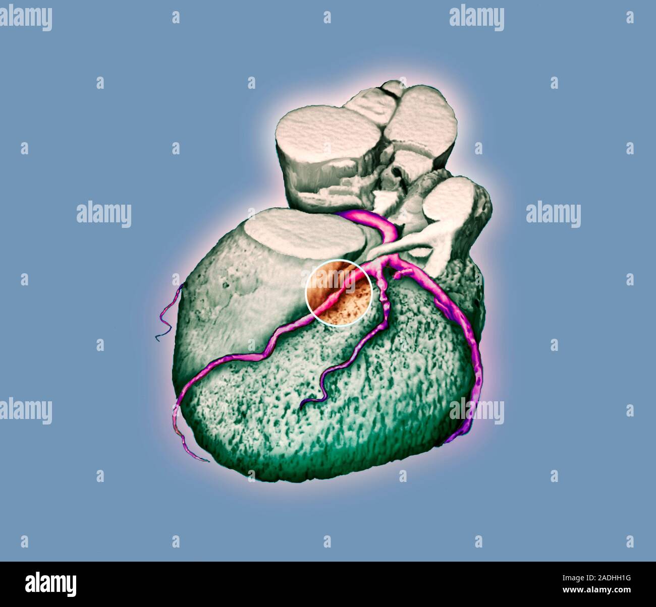 Heart disease. Coloured 3-D computed tomography (CT) scan of the heart ...
