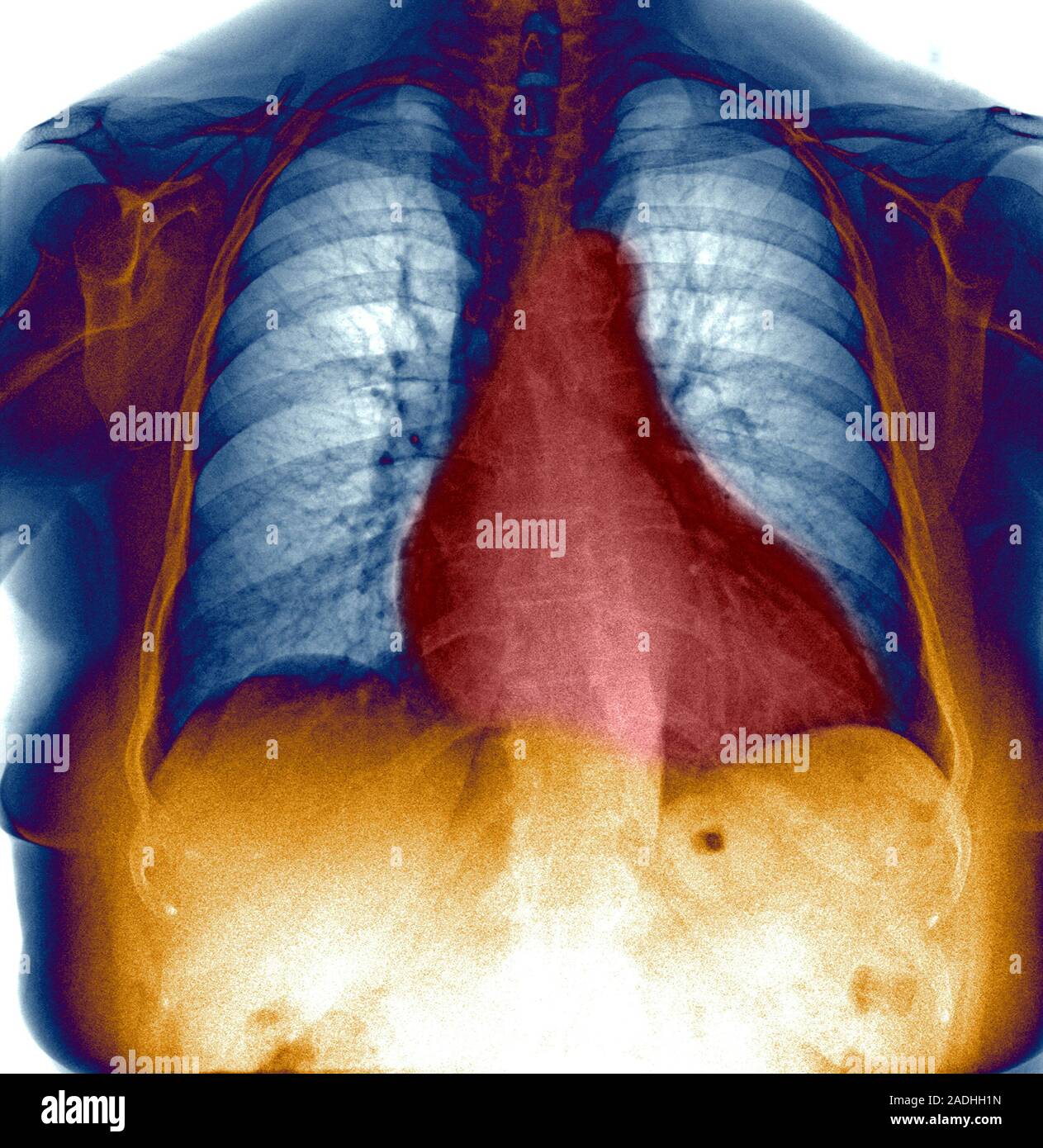 Enlarged heart. Coloured chest X-ray of a patient with gross (severe ...