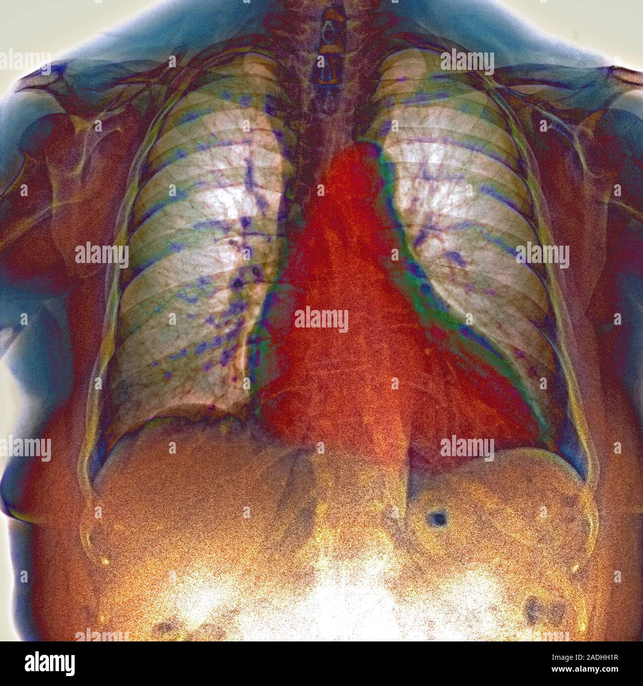 Enlarged heart. Coloured chest X-ray of a patient with gross (severe ...