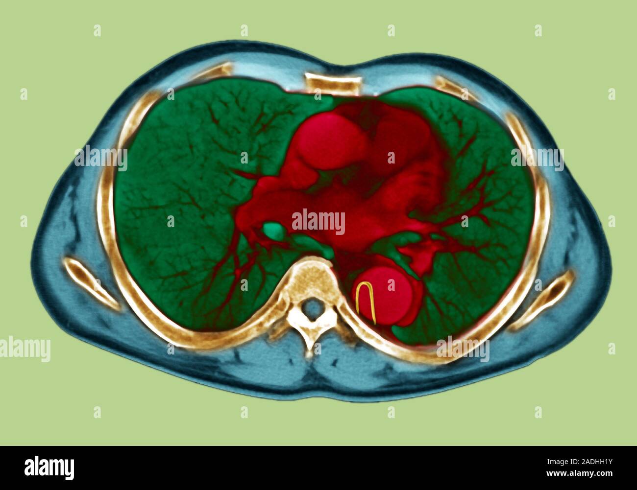 Aortic dissection. Coloured computed tomography (CT) scan of a patient ...