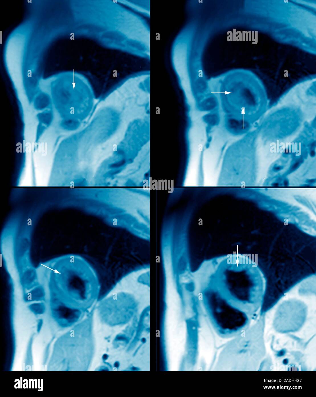 Blood clot in the heart. Sequence of magnetic resonance imaging (MRI ...