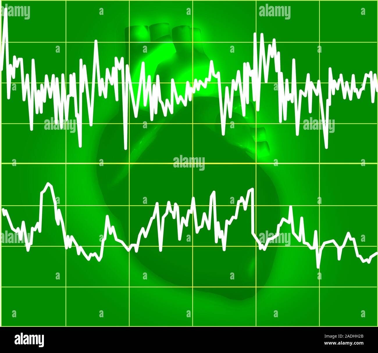 Irregular heartbeat. Computer artwork of ECC (electrocardiogram) traces ...