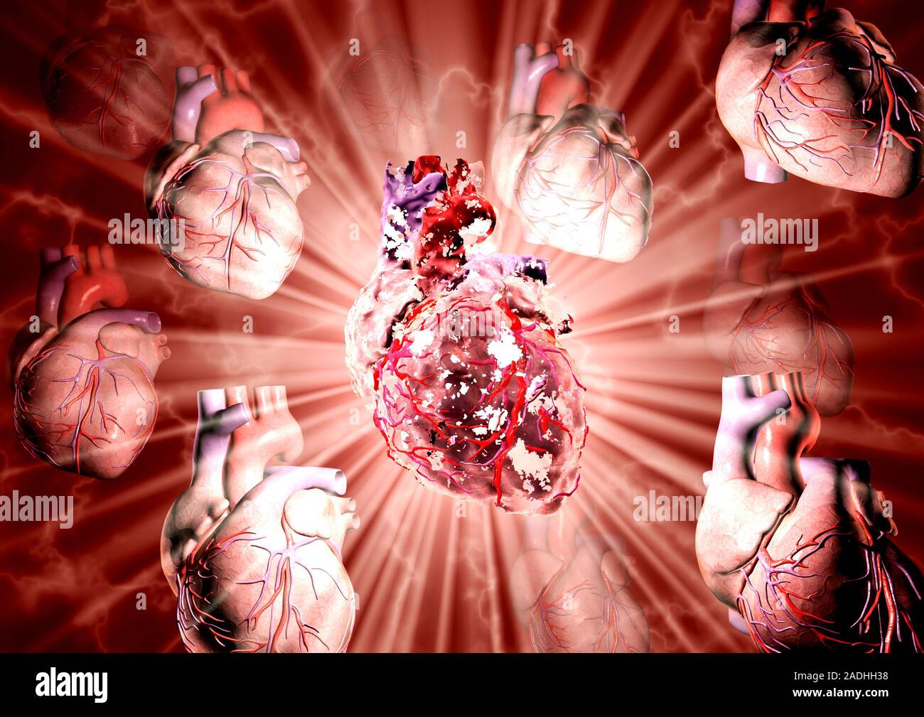 Heart attack. Conceptual computer artwork representing a myocardial ...