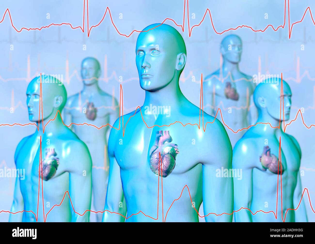 Irregular heartbeat. Computer artwork of ECG (electrocardiogram) traces ...