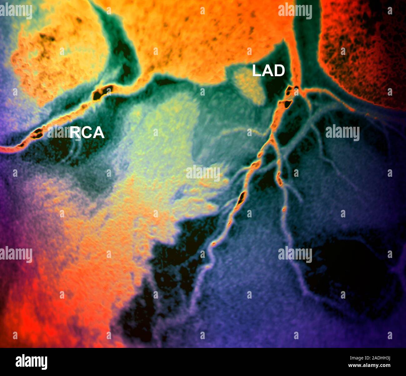 Narrowed heart arteries. Coloured computed tomography (CT) scan of the ...