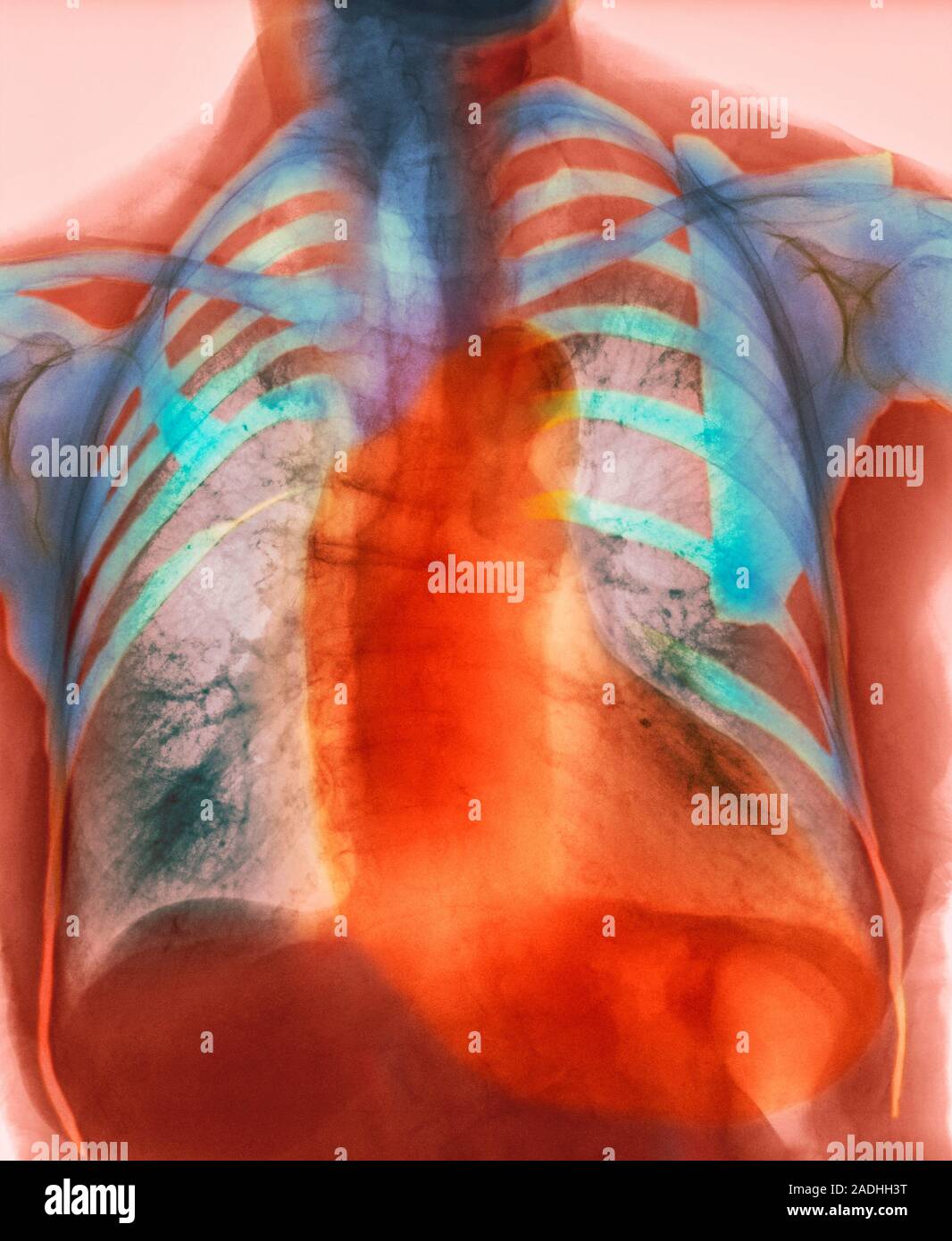 Enlarged heart. Coloured chest X-ray of a 91 year old woman showing ...