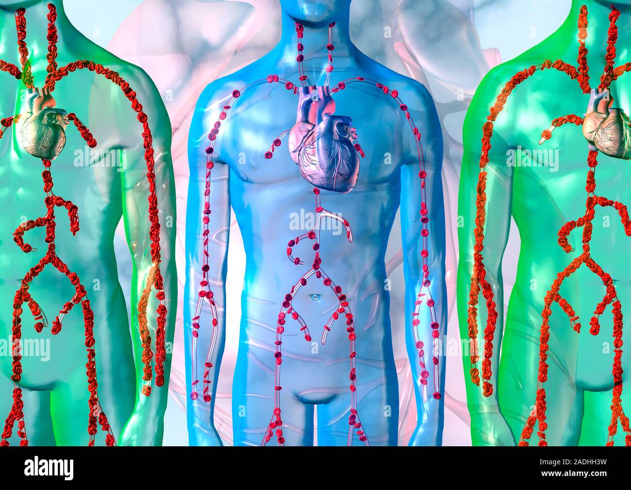 Heart failure. Conceptual computer artwork of a person with heart ...