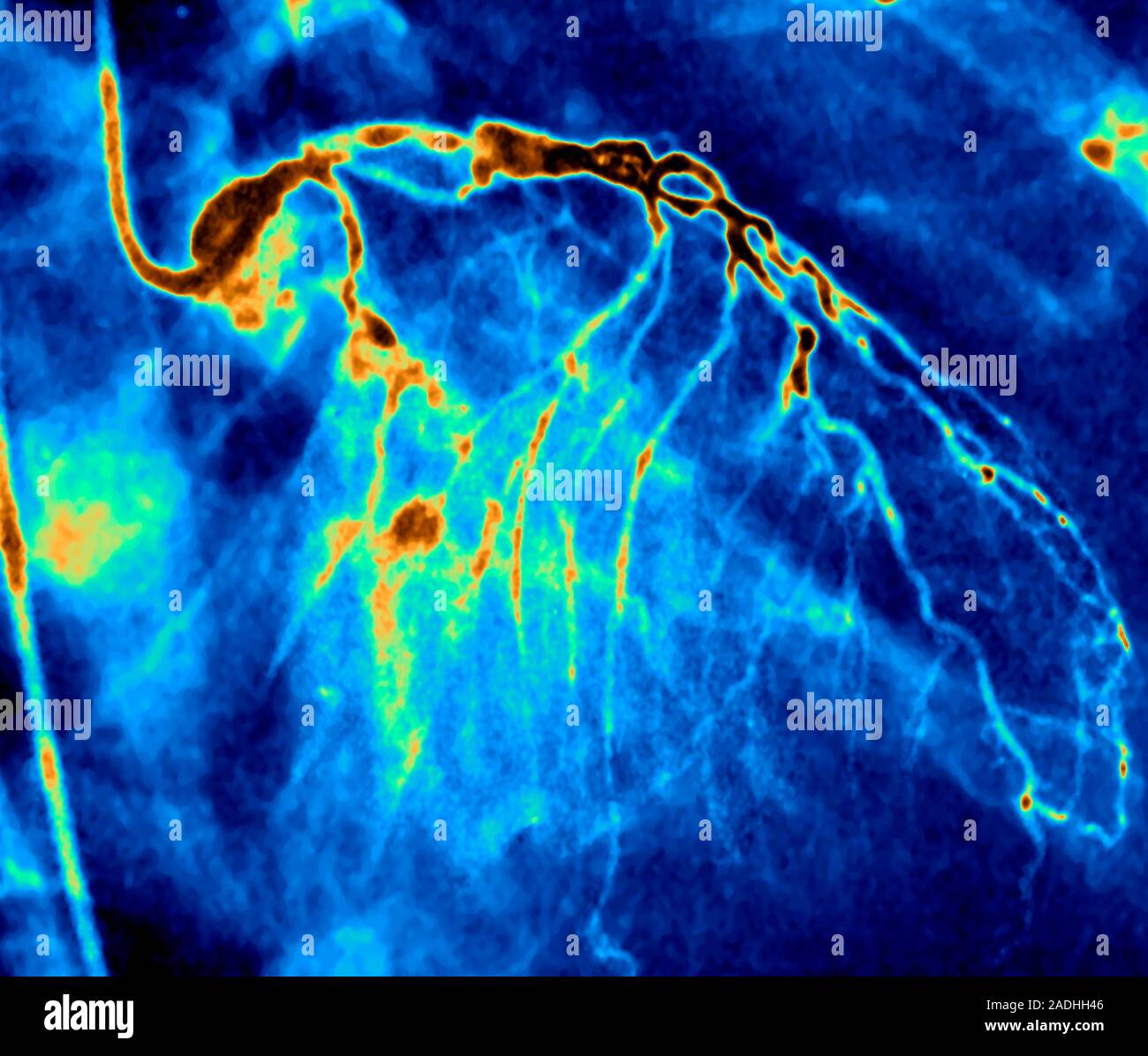 Narrowed coronary arteries. Coloured coronary angiogram (X-ray) of a 65 ...
