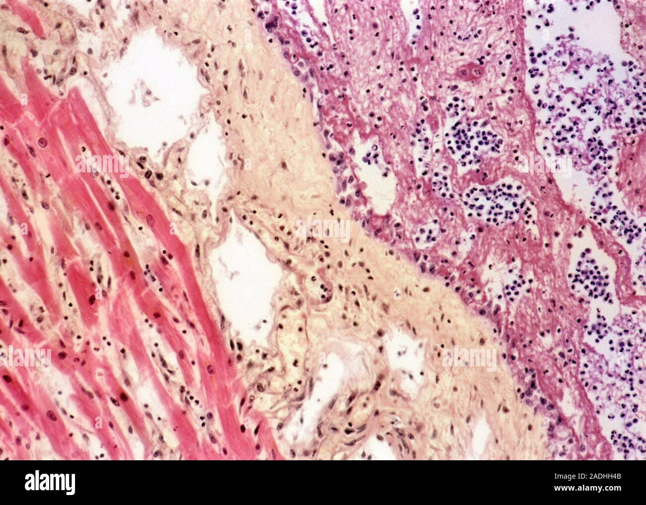 Inflamed heart sac. Light micrograph of a section through a human heart ...