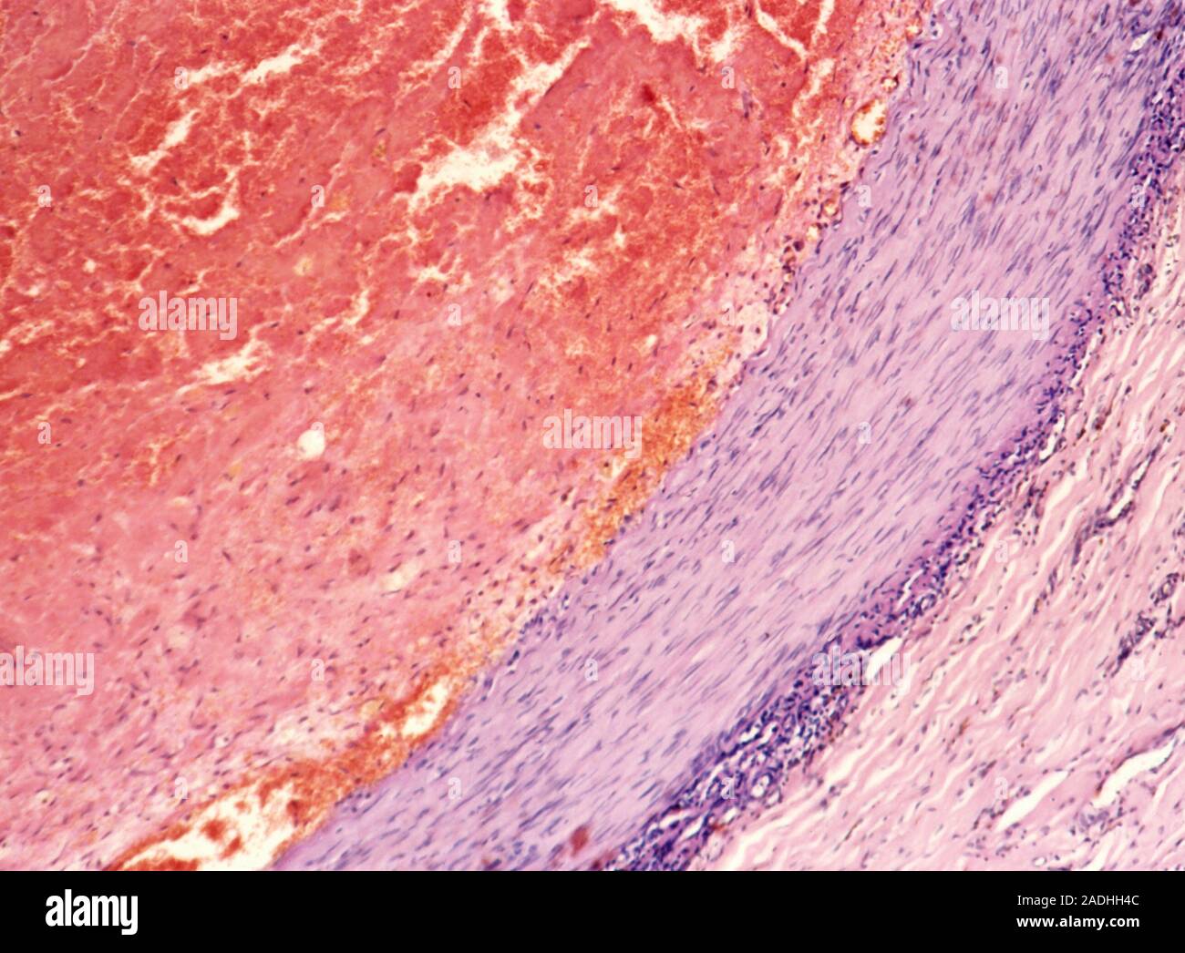 Coronary thrombosis. Light micrograph (LM) of part of a thrombus (red ...