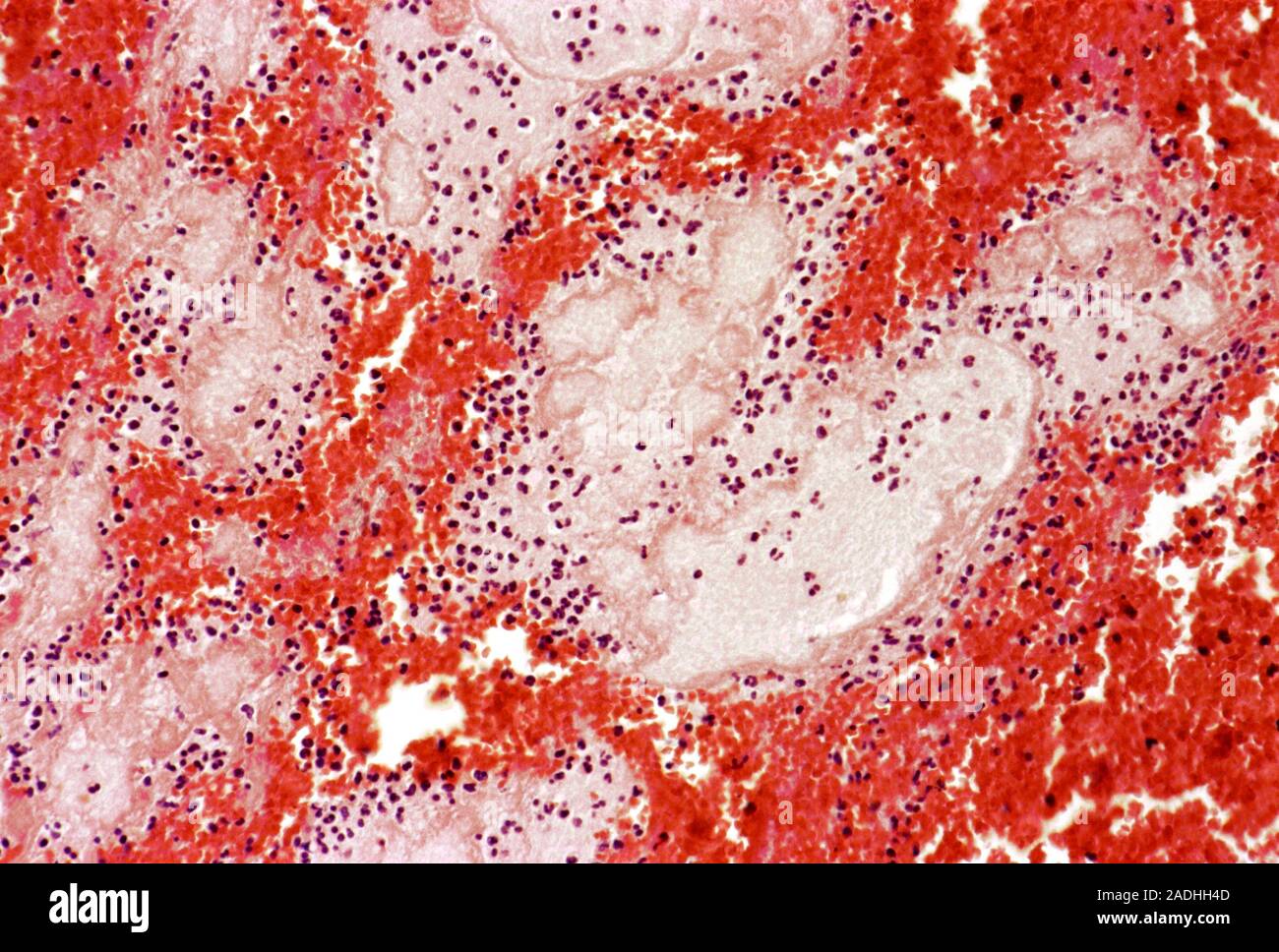 Coronary thrombosis. Light micrograph of a section through a thrombus ...