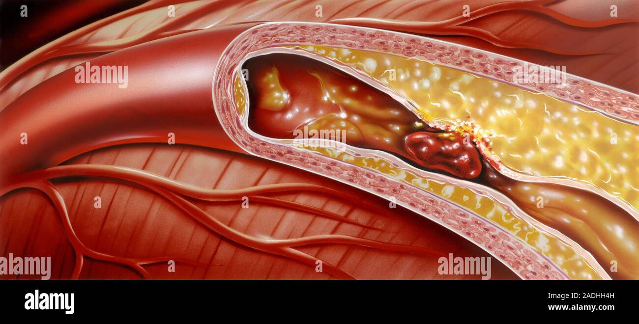 Blocked coronary artery. Computer artwork of a clot (red) in a coronary ...