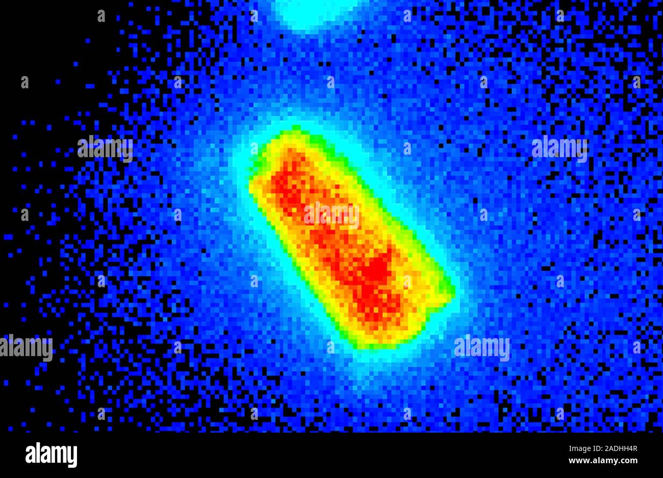 Calcium overload in heart cell, fluorescent light micrograph. This is ...